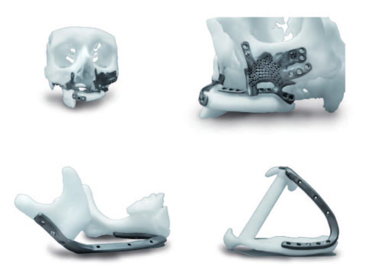 KLS Martin - Aleamed